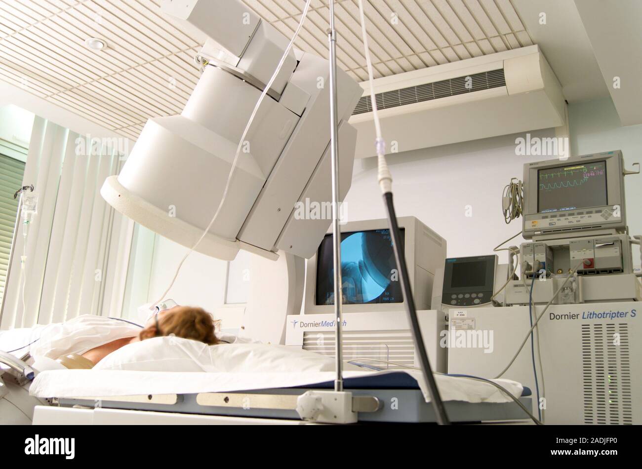 Lithotripsy treatment. Patient receiving lithotripsy treatment for a ...