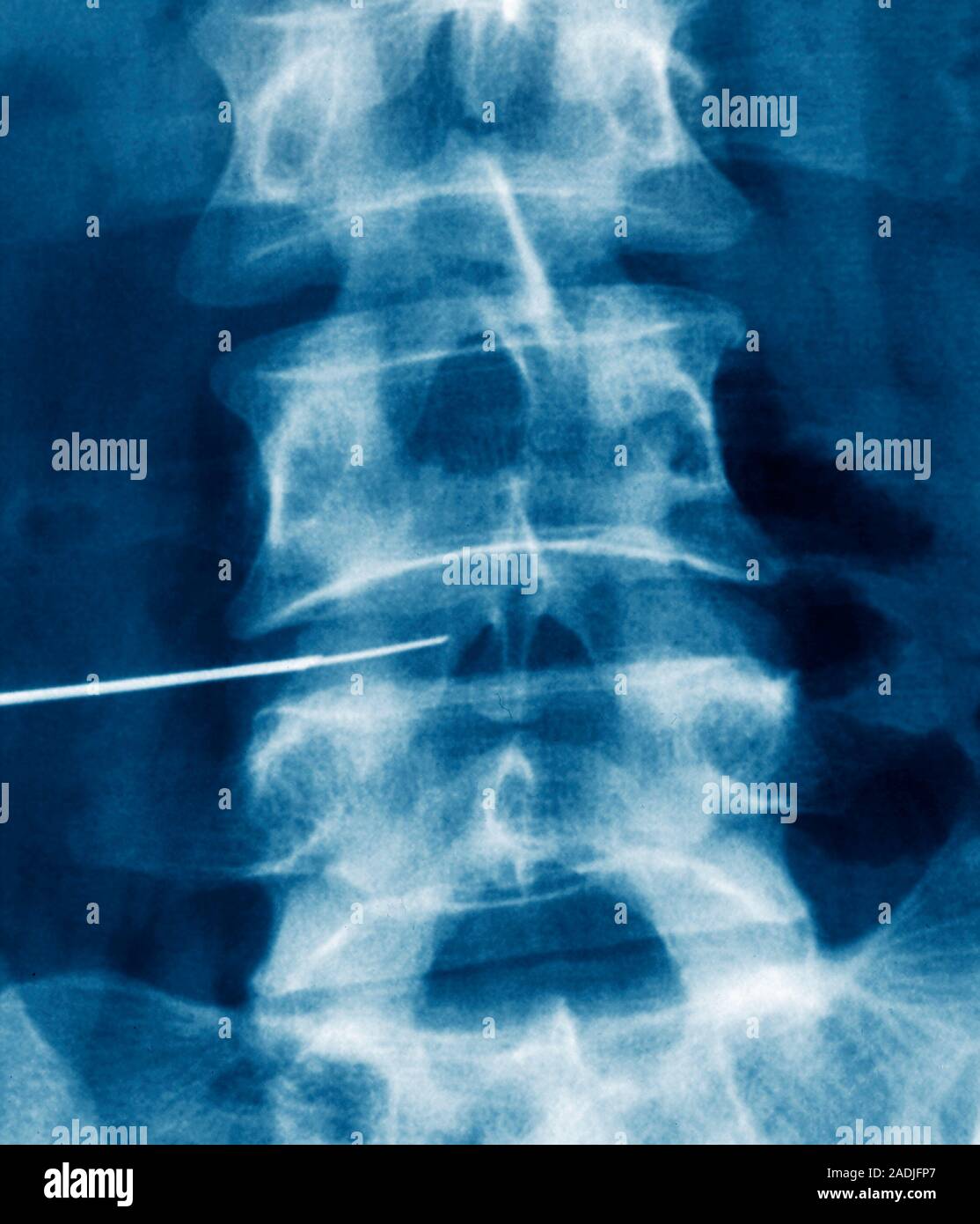 Slipped disc treatment. X-ray of the lumbar (lower) spine of a patient ...