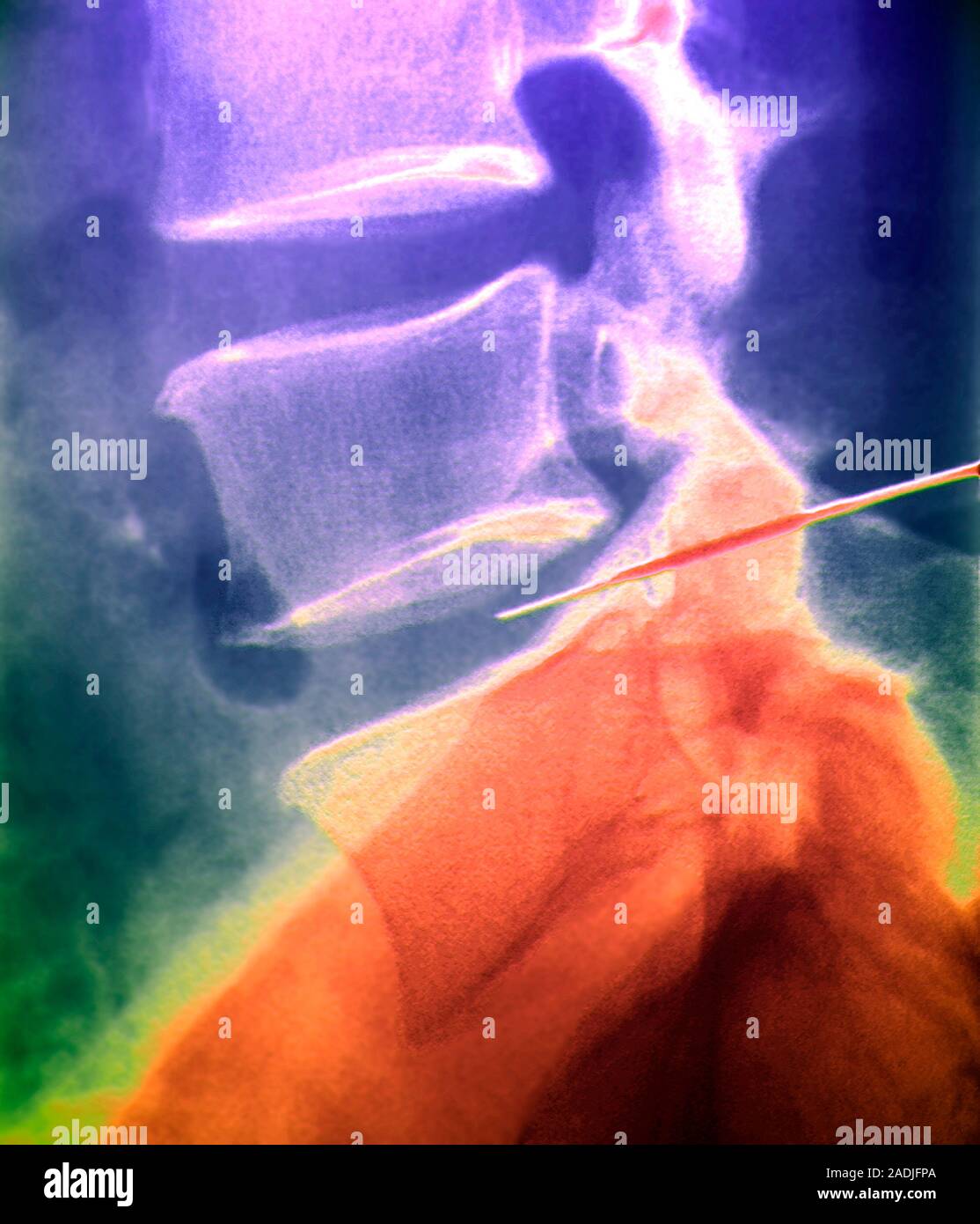 Slipped disc treatment. Coloured X-ray (side view) of the lumbar (lower ...