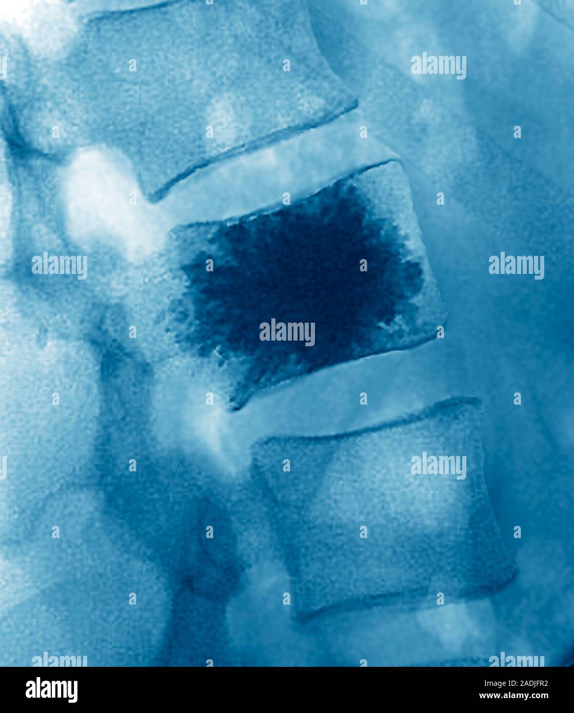 Spinal collapse treatment. Coloured side X-ray of the lumbar spine of a ...