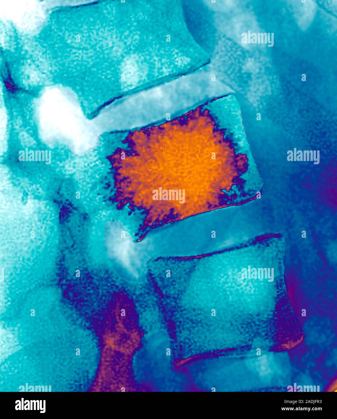 Spinal collapse treatment. Coloured side X-ray of the lumbar spine of a ...