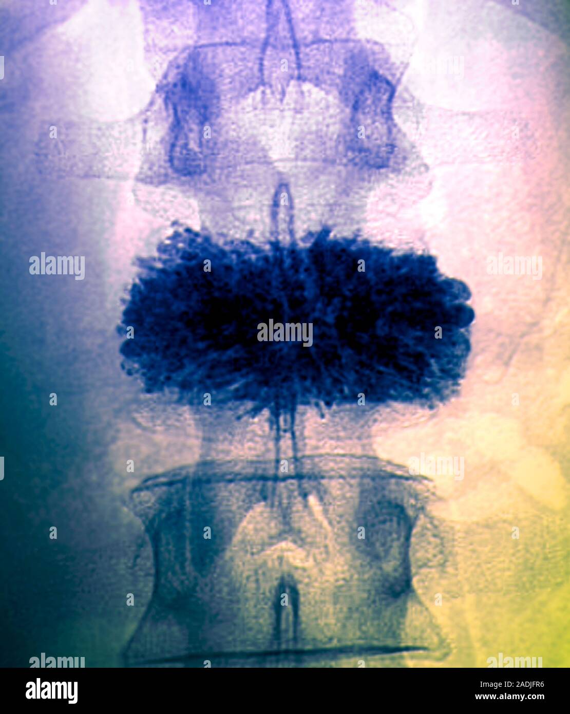 Spinal collapse treatment. Coloured frontal X-ray of the lumbar spine ...