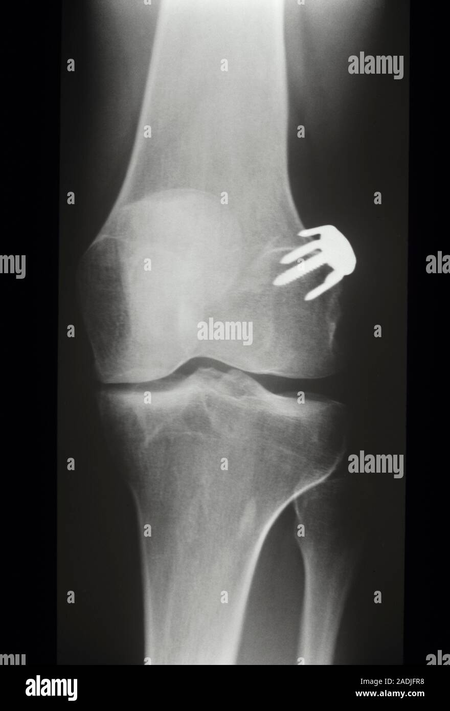 Stapled ligament. X-ray of the knee of a patient with a staple inserted ...