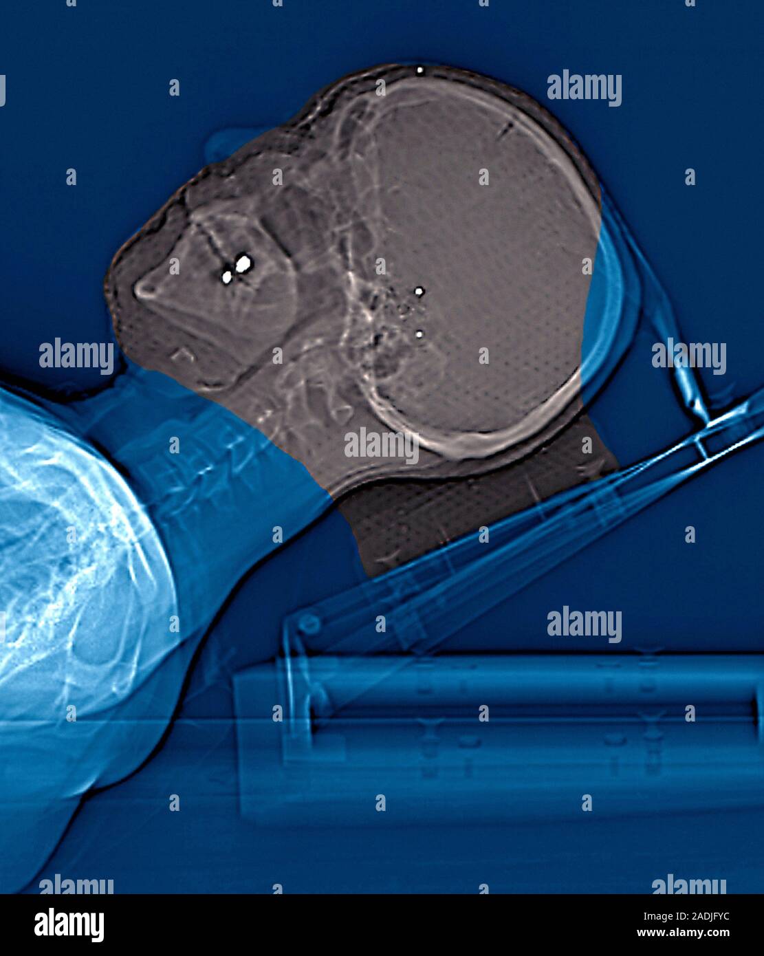 Radiotherapy for brain cancer. Coloured computed tomography (CT) scan of the head of a patient ...