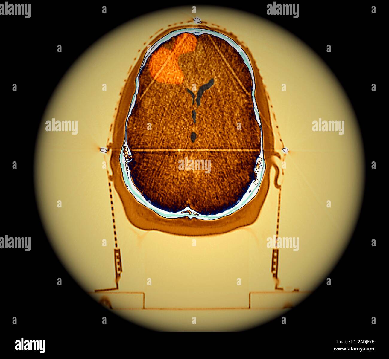Radiotherapy for brain cancer. Coloured computed tomography (CT) scan ... Radiotherapy for brain cancer. Coloured computed tomography (CT) scan ...