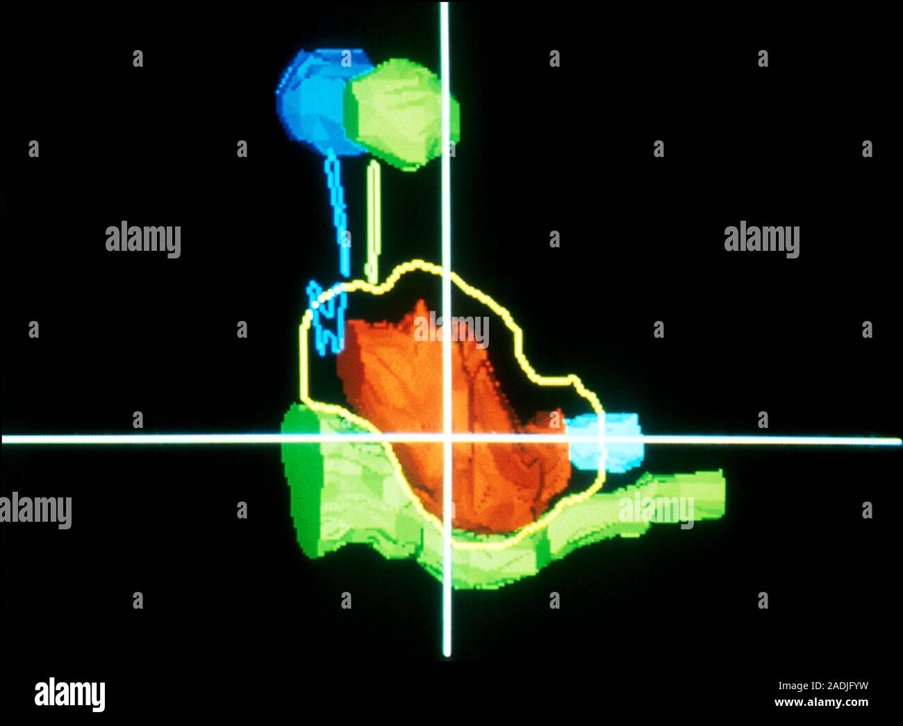 Proton therapy cancer treatment, coloured computed tomography (CT) scan ...