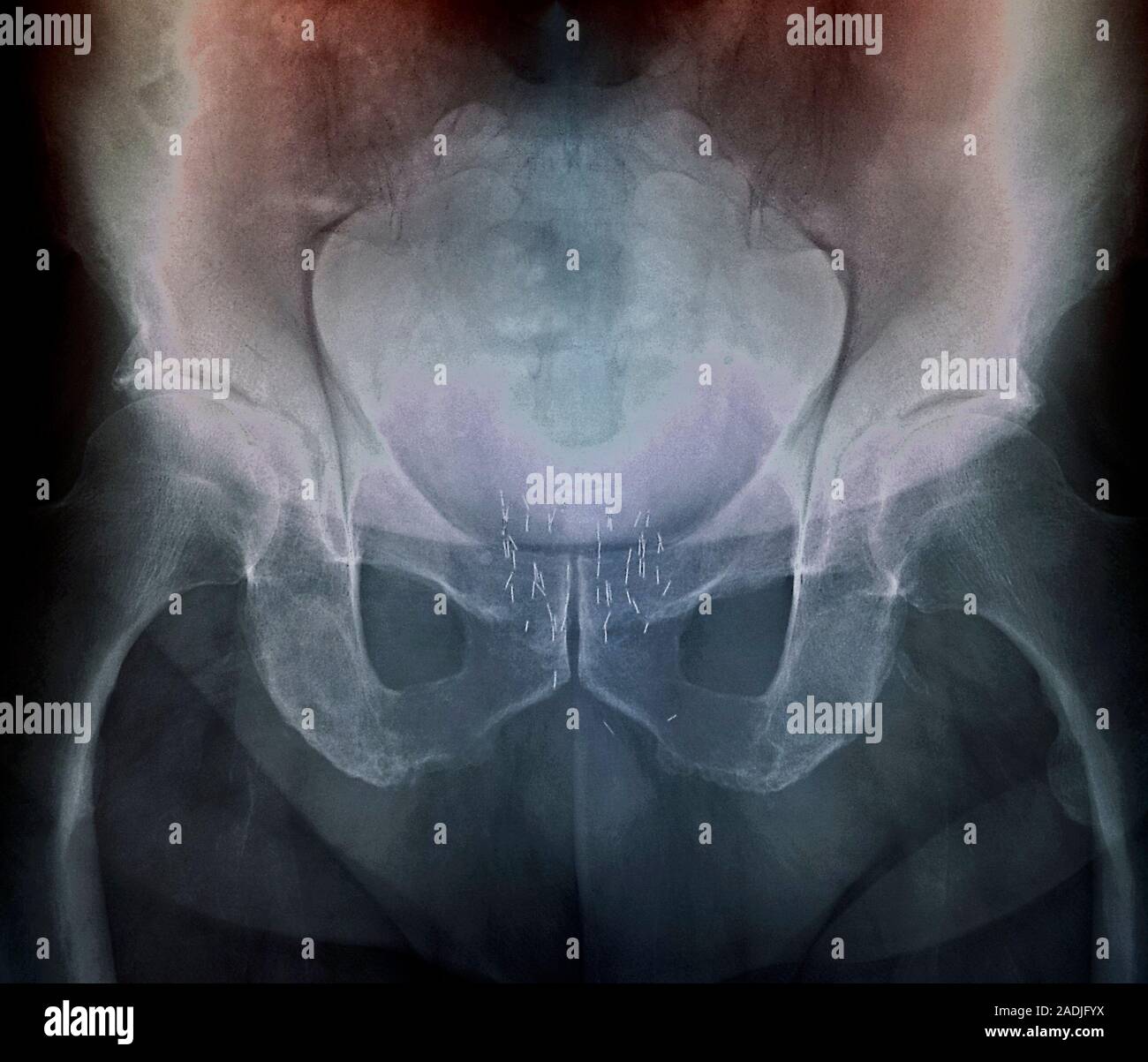 Prostate cancer treatment. Coloured frontal X-ray image of the pelvis ...