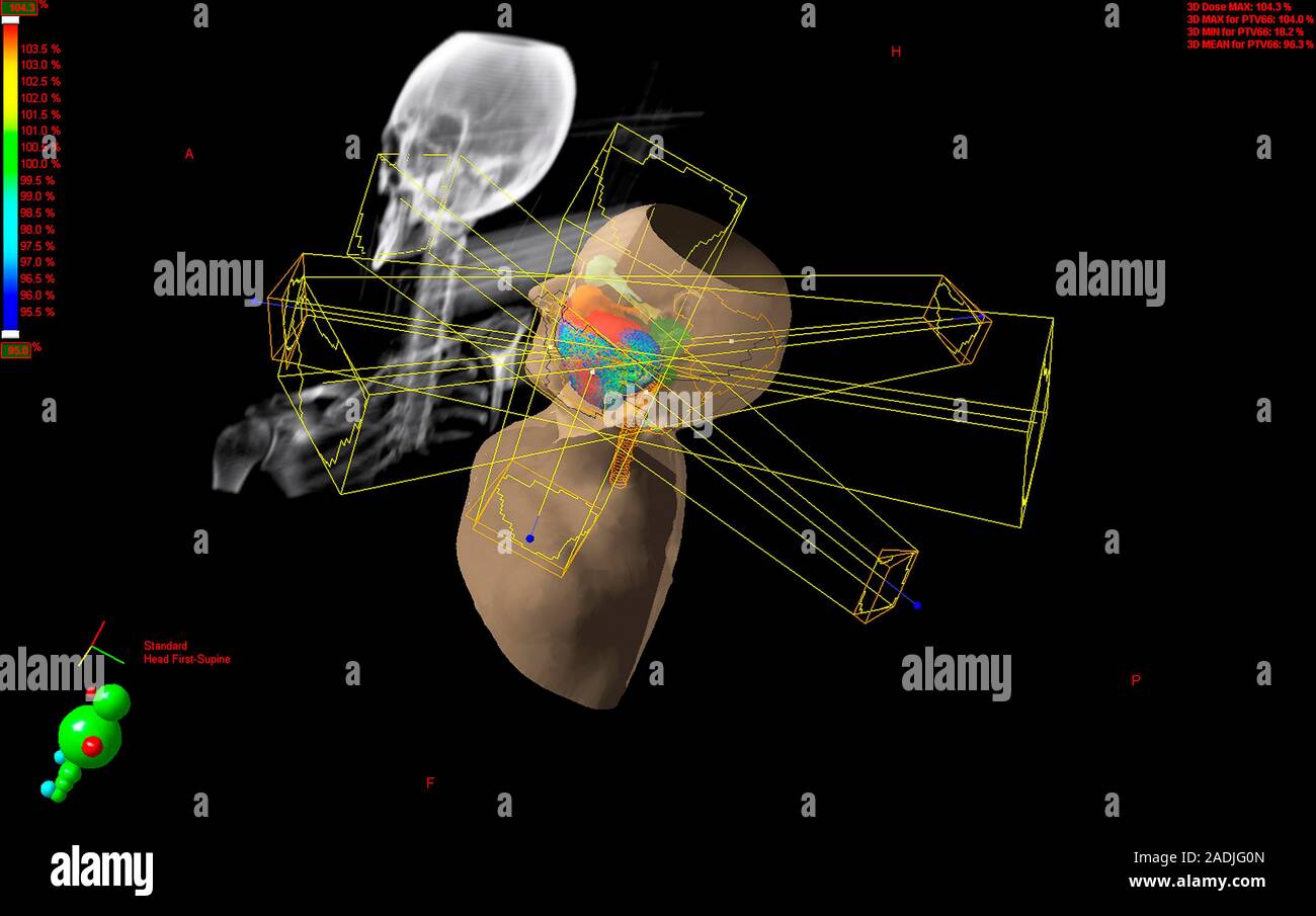 Cancer treatment plan. Screenshot of a radiotherapy treatment plan for ...