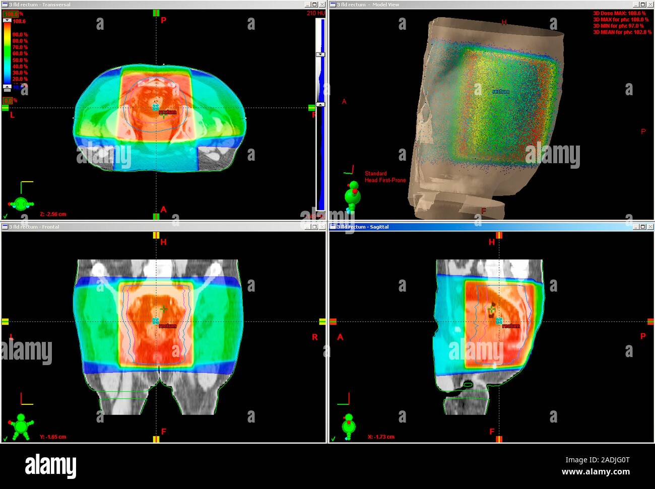 Cancer treatment plan. Screenshot of four different angles of a ...