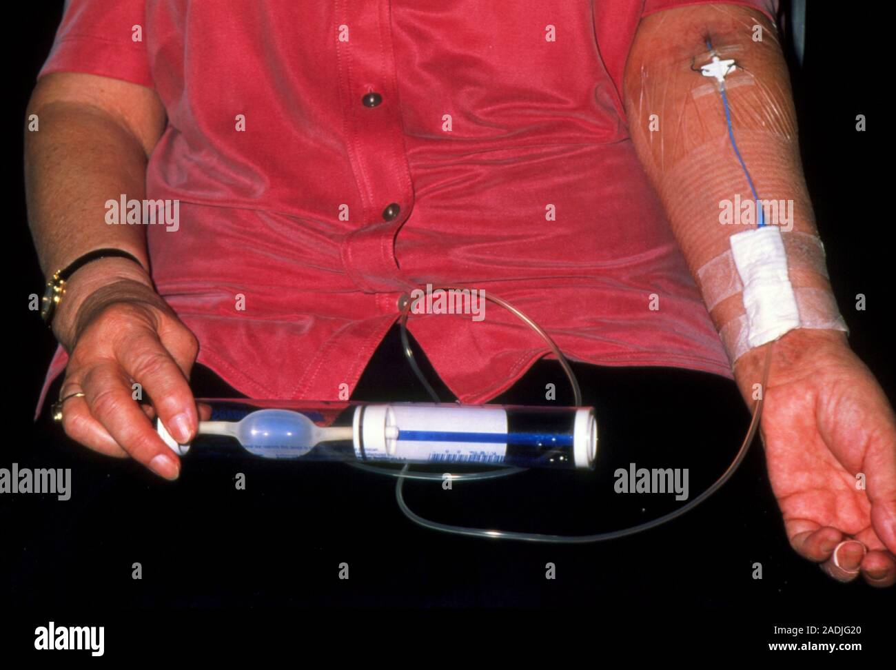 Intravenous chemotherapy. View of a 67 year old woman using a PICC line ...