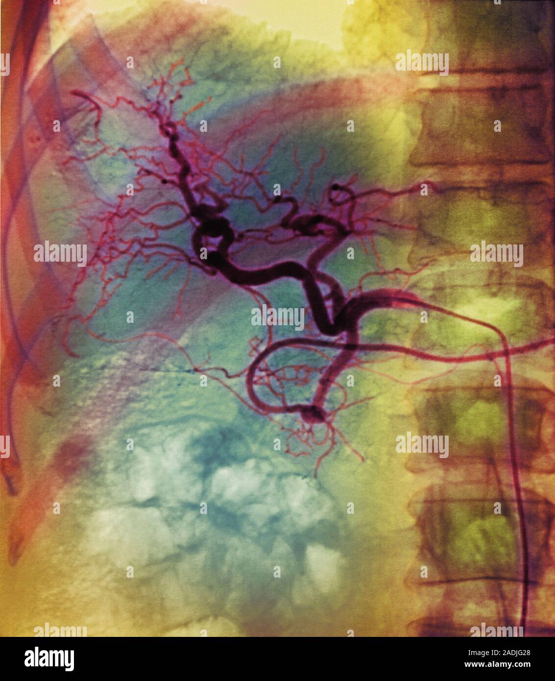 Liver cancer treatment. Coloured X-ray angiogram of a catheter being ...