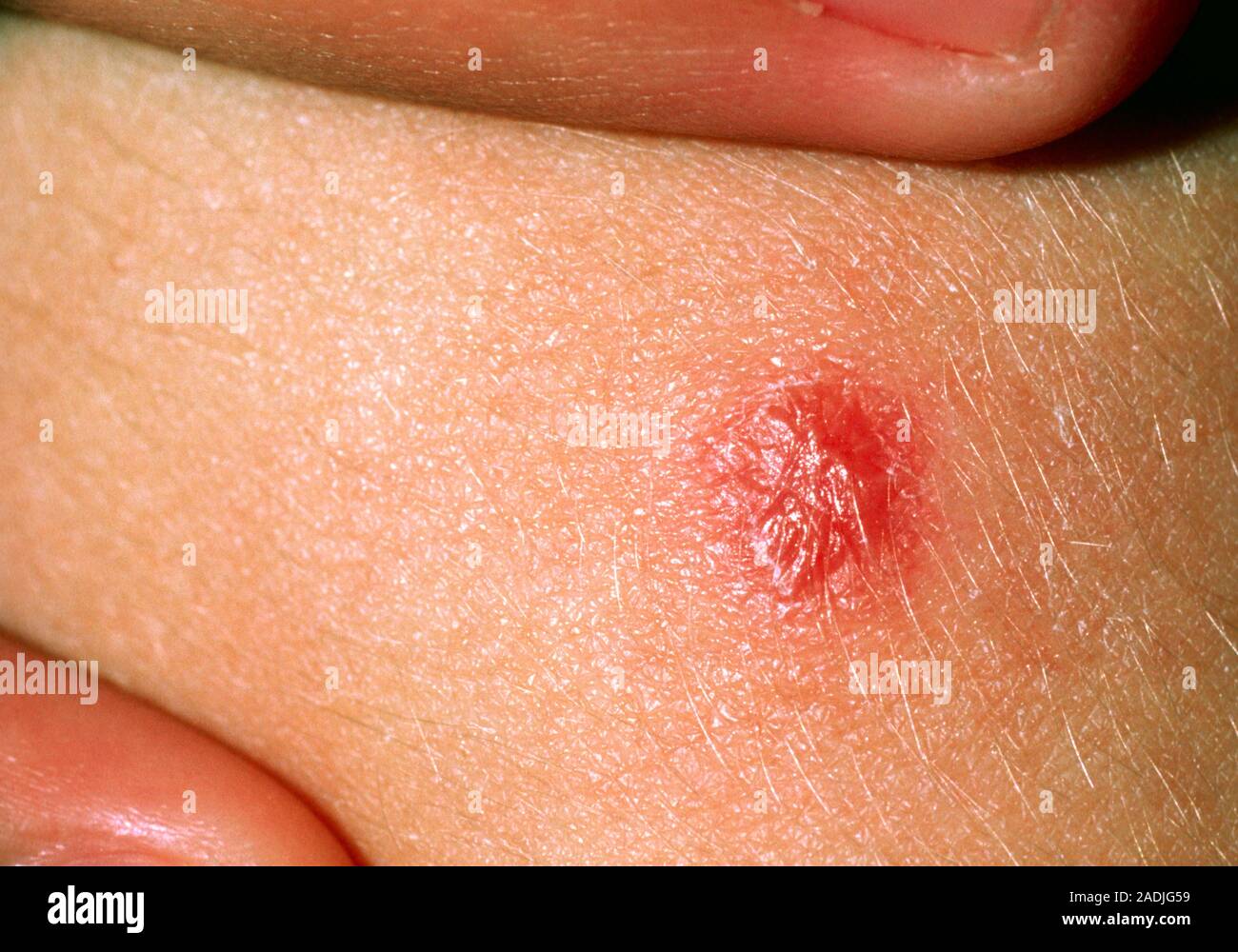 Tuberculosis (TB) vaccination. Normal local skin reaction on day 40 ...