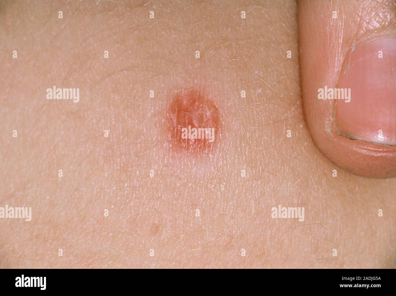 Tuberculosis (TB) vaccination. Normal local skin reaction on day 82 ...