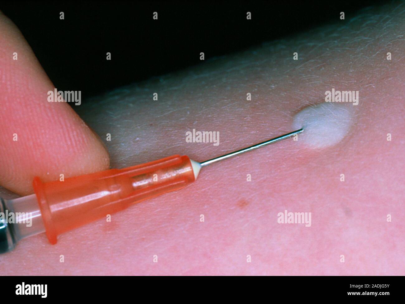 BCG (Tuberculosis) vaccination. Injection needle is inserted ...