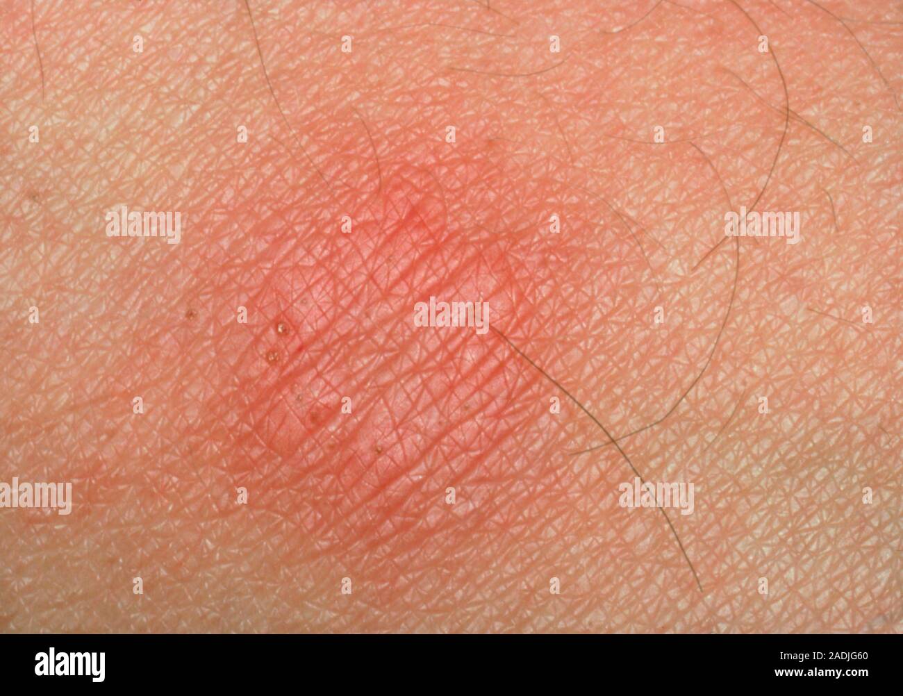Heaf test for TB. Close-up of a red patch of skin, indicating a ...
