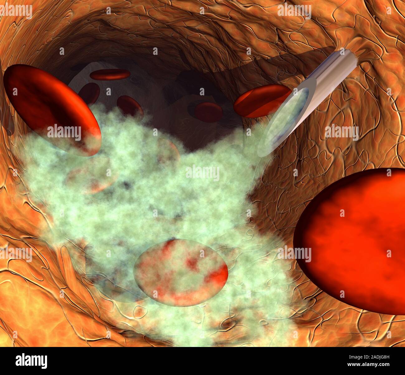 Injection. Computer artwork of a drug being injected into a vein by a ...