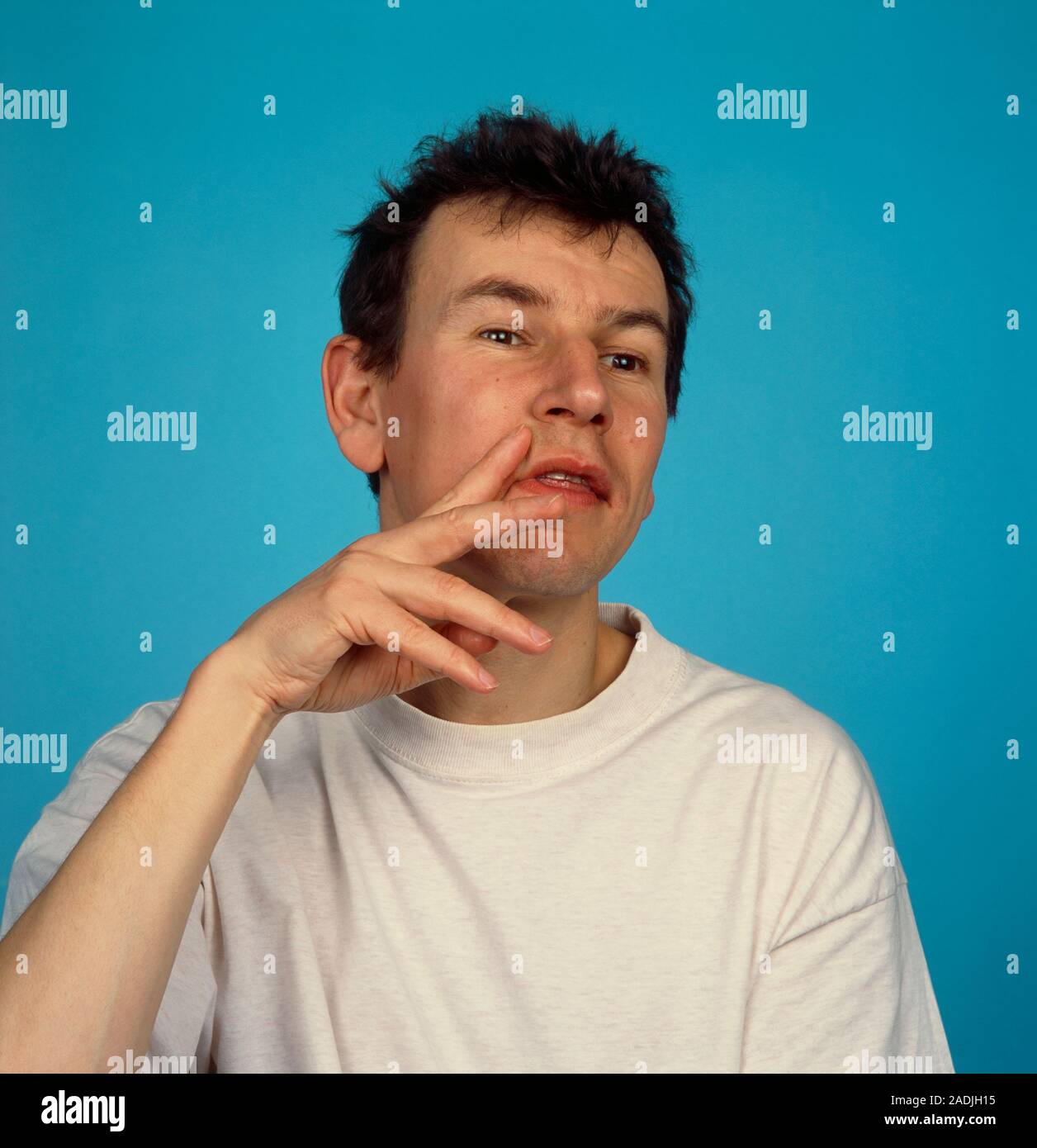 MODEL RELEASED. Hemiplegia. Stroke patient with left-side paralysis ...