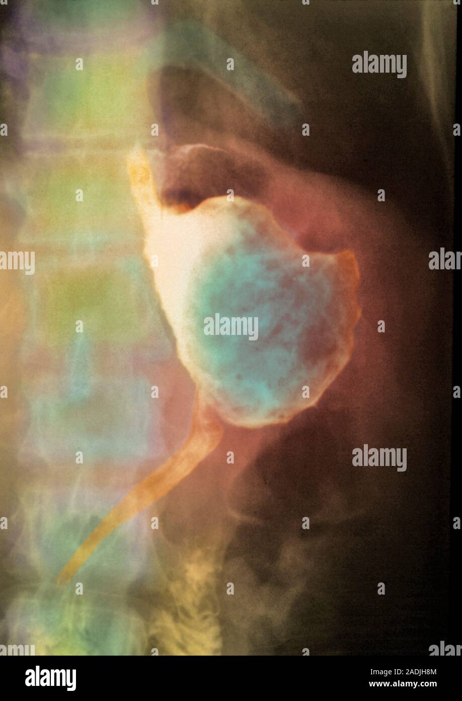 Stomach cancer treatment. Post-operative coloured X- ray of a patient's ...