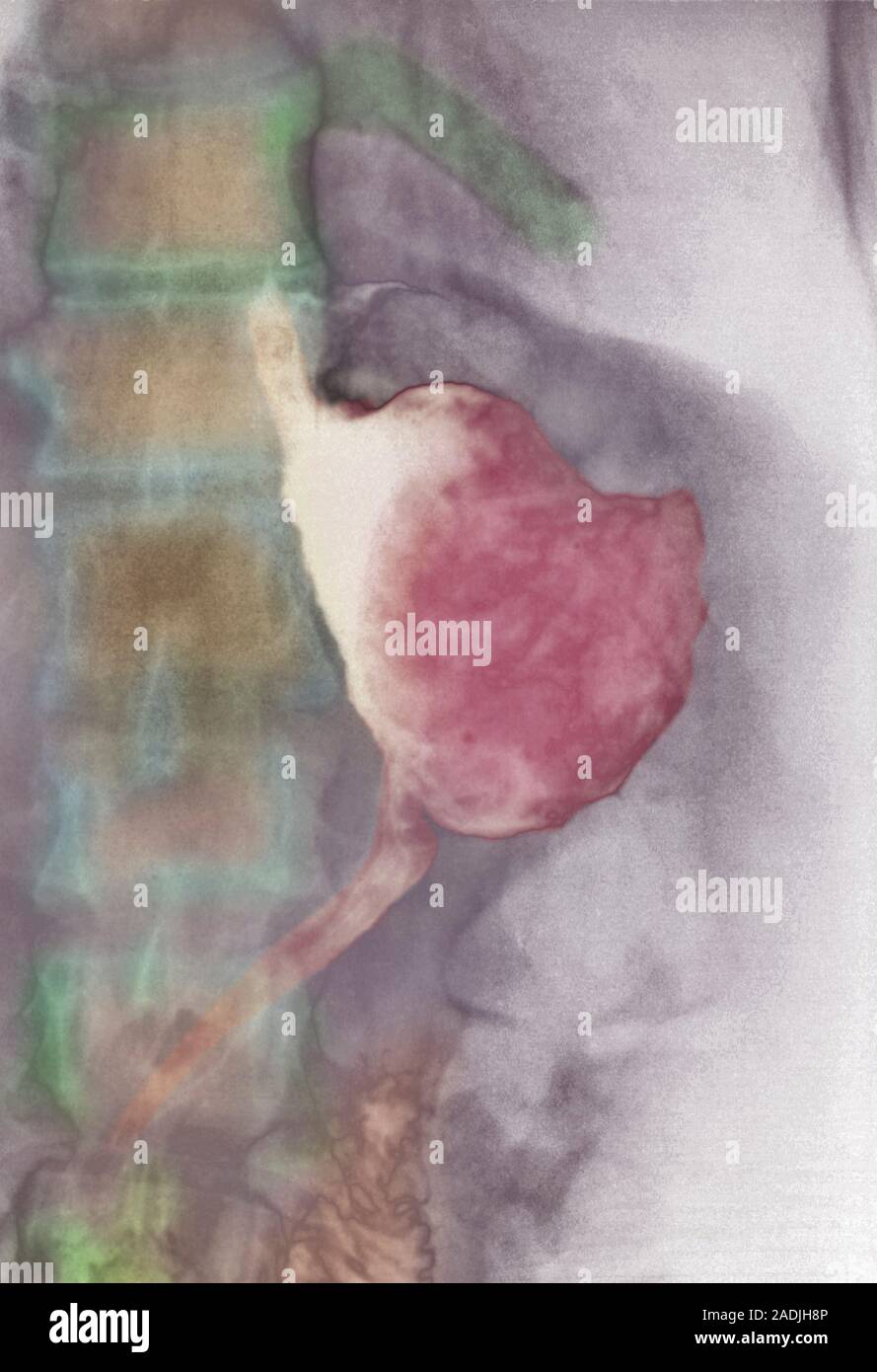 Stomach cancer treatment. Post-operative coloured X- ray of a patient's ...
