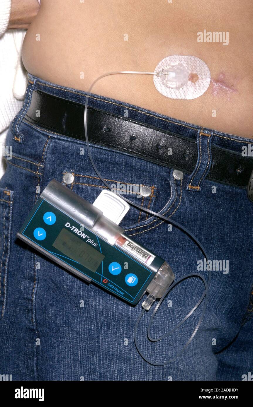 Insulin pump attached to the abdomen of a 37 year old woman. The pump ...
