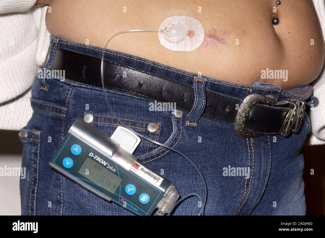 Insulin pump attached to the abdomen of a 37 year old woman. The pump ...