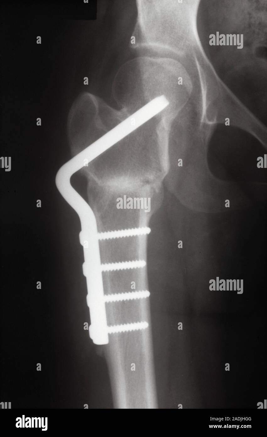 Pinned arthritic hip. X-ray of a patient with a pinned femur (thigh ...