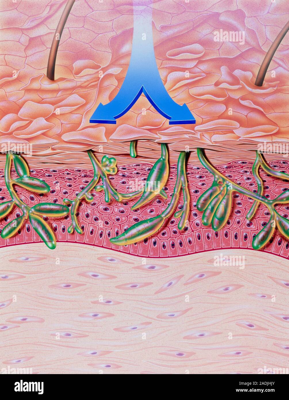 Treatment of fungal infection. Illustration show- ing the point of ...