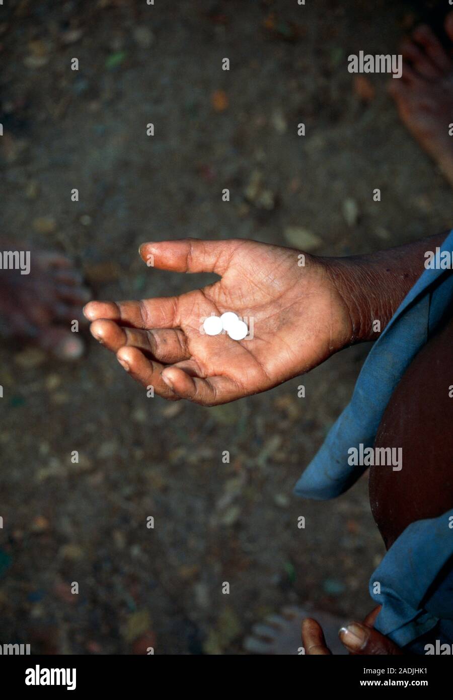 Elephantiasis drugs. Hand holding elephantiasis (lymphatic filariasis ...