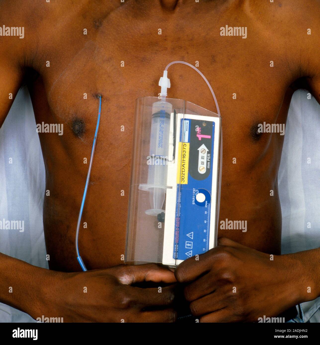 Drug pump. Drug pump used in the treatment of sickle cell anaemia with ...