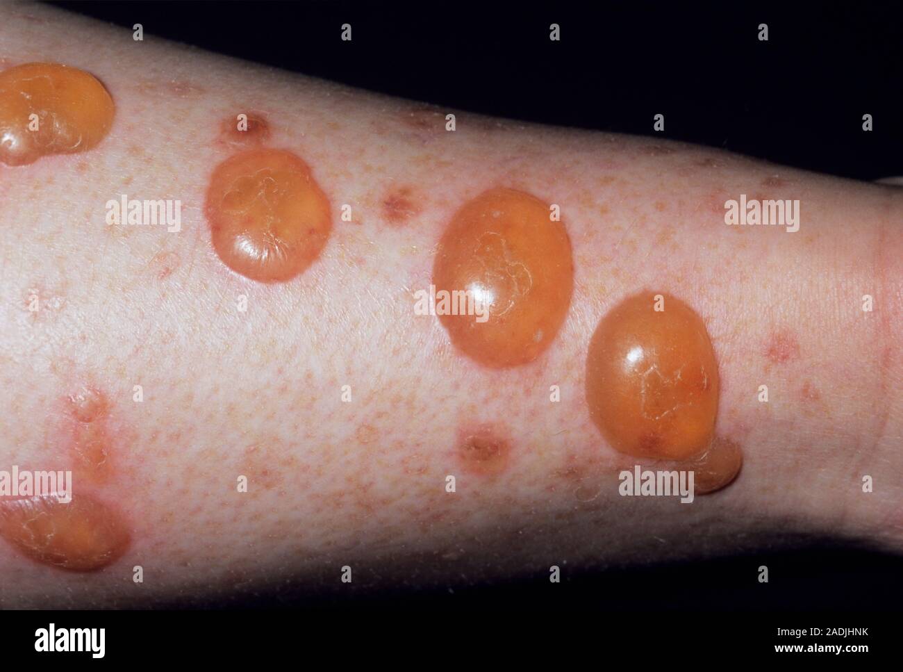 Blisters on the arm of a 47-year-old woman 5 days after treatment for ...