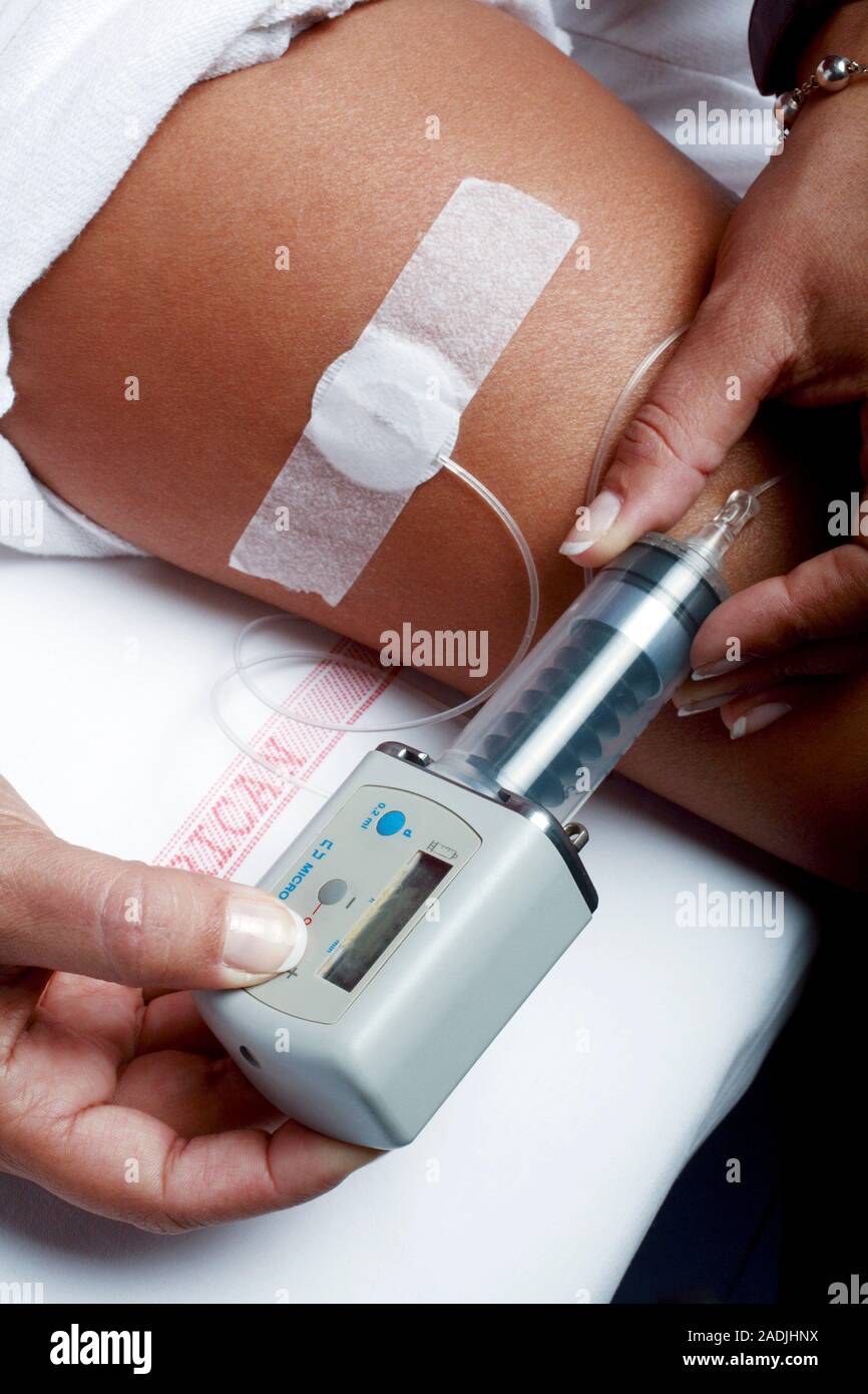 Thalassaemia treatment. Ambulatory drug infusion pump being used to ...