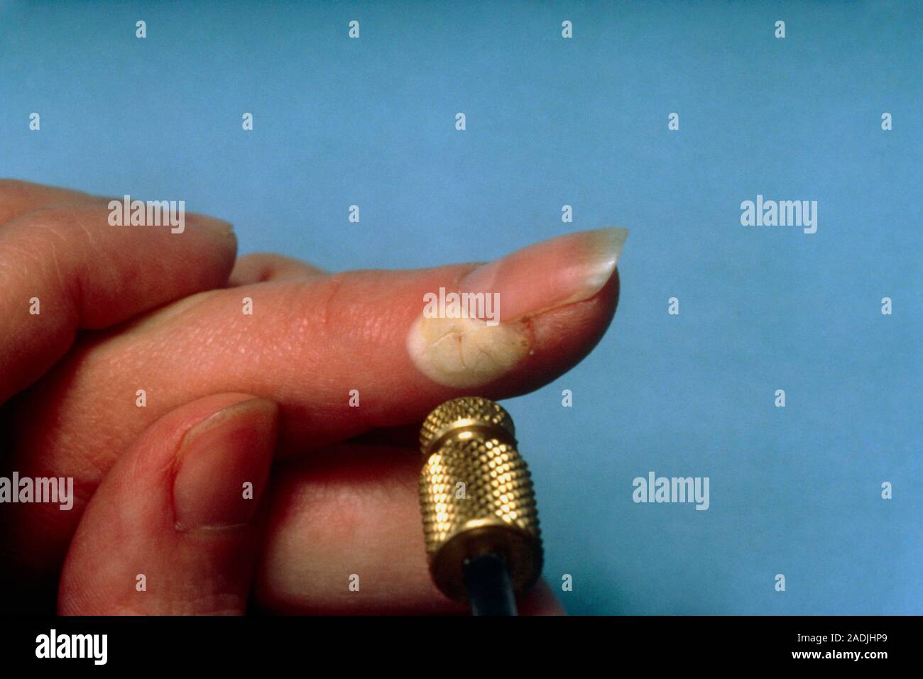 Removal of viral wart (verruca) on the finger by freezing with liquid ...