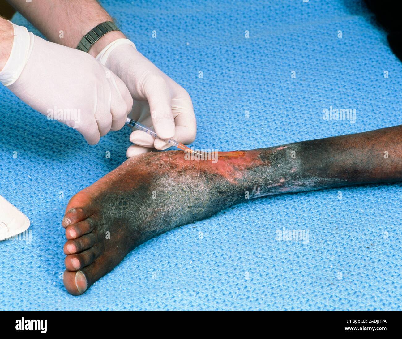 Ulcer treatment with GM-CSF drug. Gloved hands inject a genetically ...