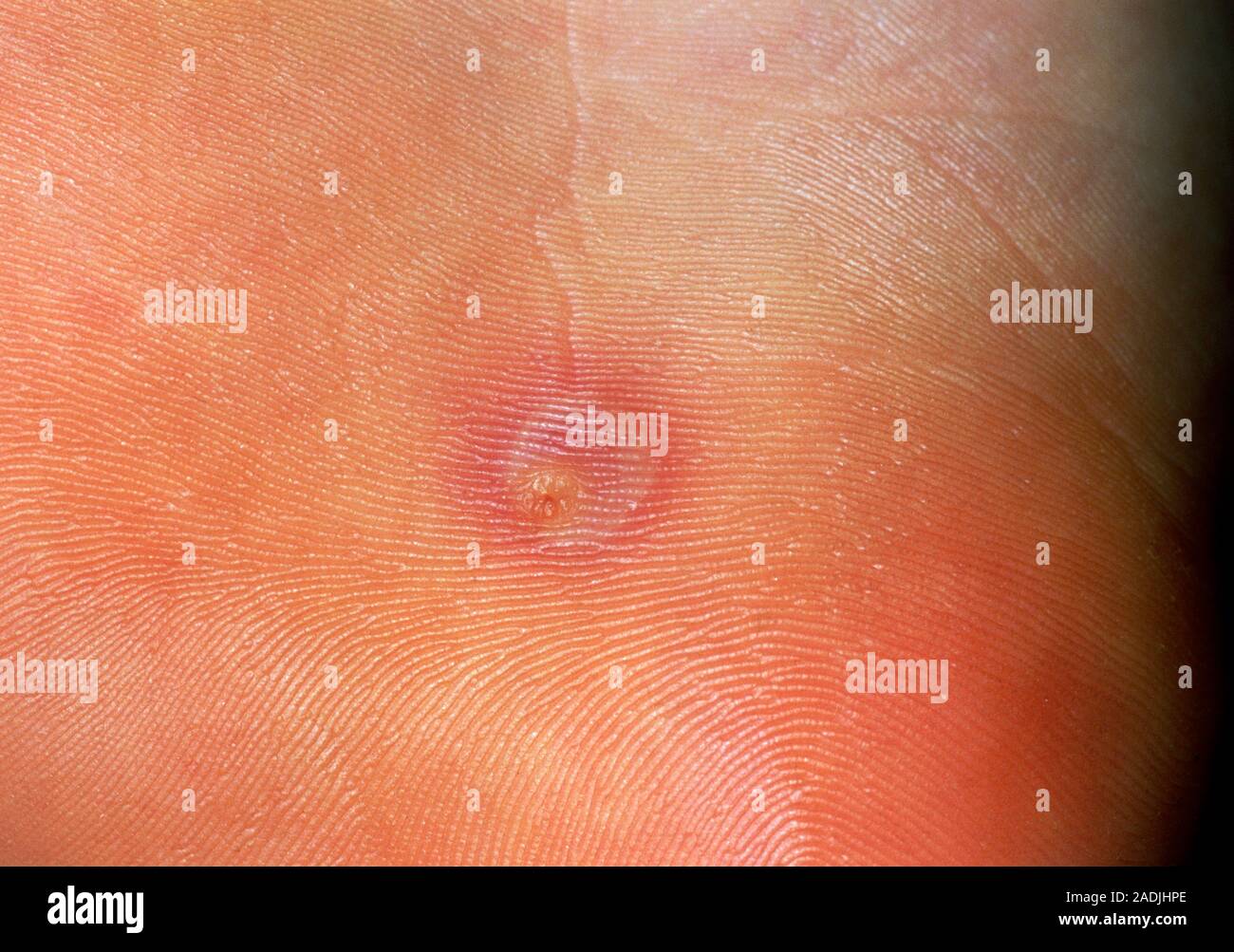 Blister after verruca treatment. View of a blister on the foot of a ten ...