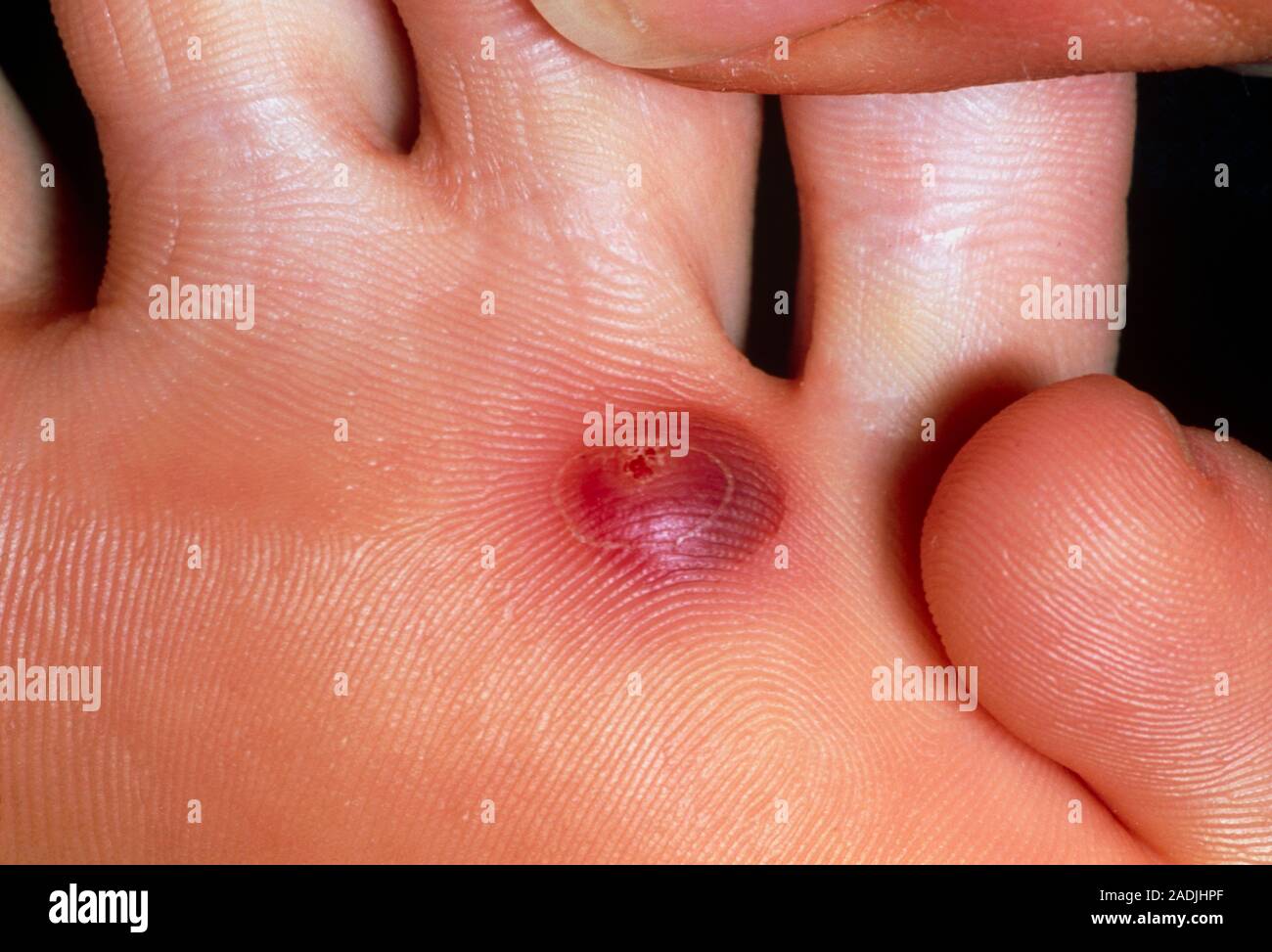 Blister after verruca treatment. View of a blood blister on the foot of ...