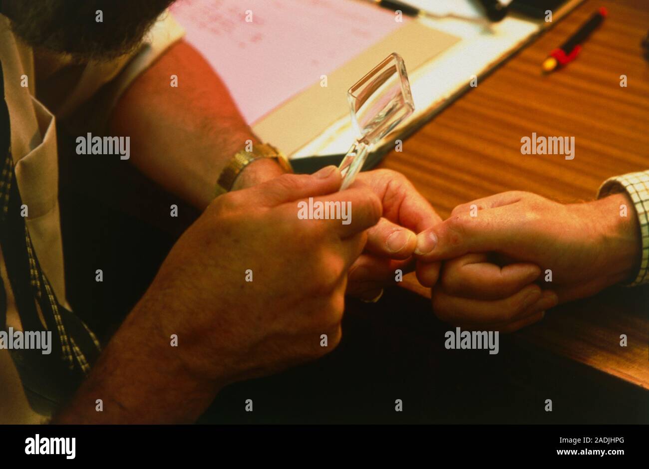 Wart treatment. General practice doctor using a magnifying glass to ...
