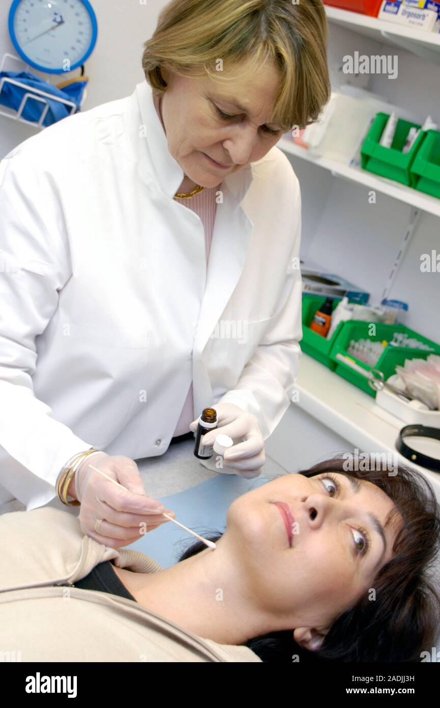 MODEL RELEASED. Cryotherapy. Dermatologist applying liquid nitrogen to ...