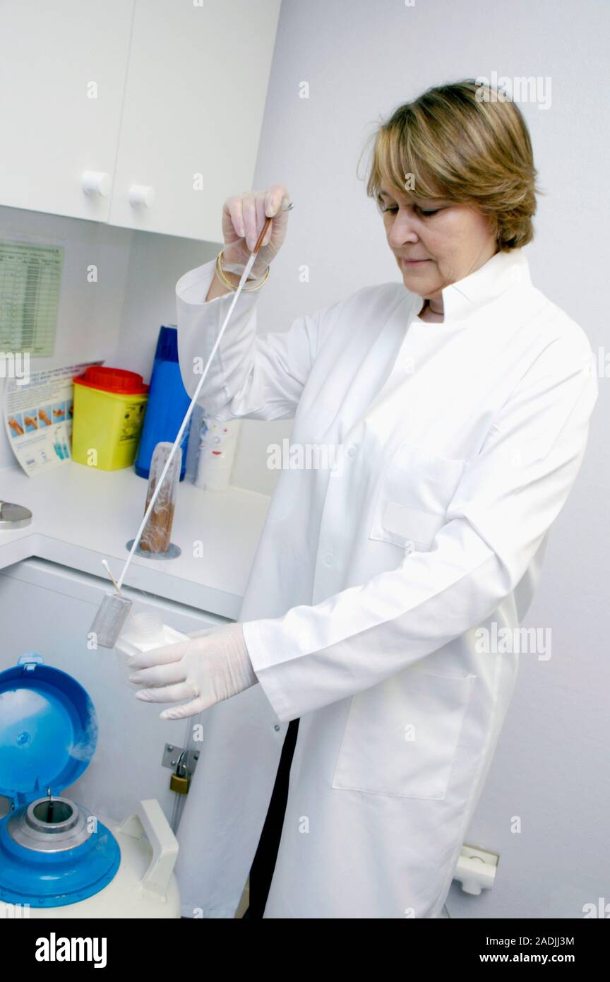 MODEL RELEASED. Cryotherapy. Dermatologist pouring liquid nitrogen from ...