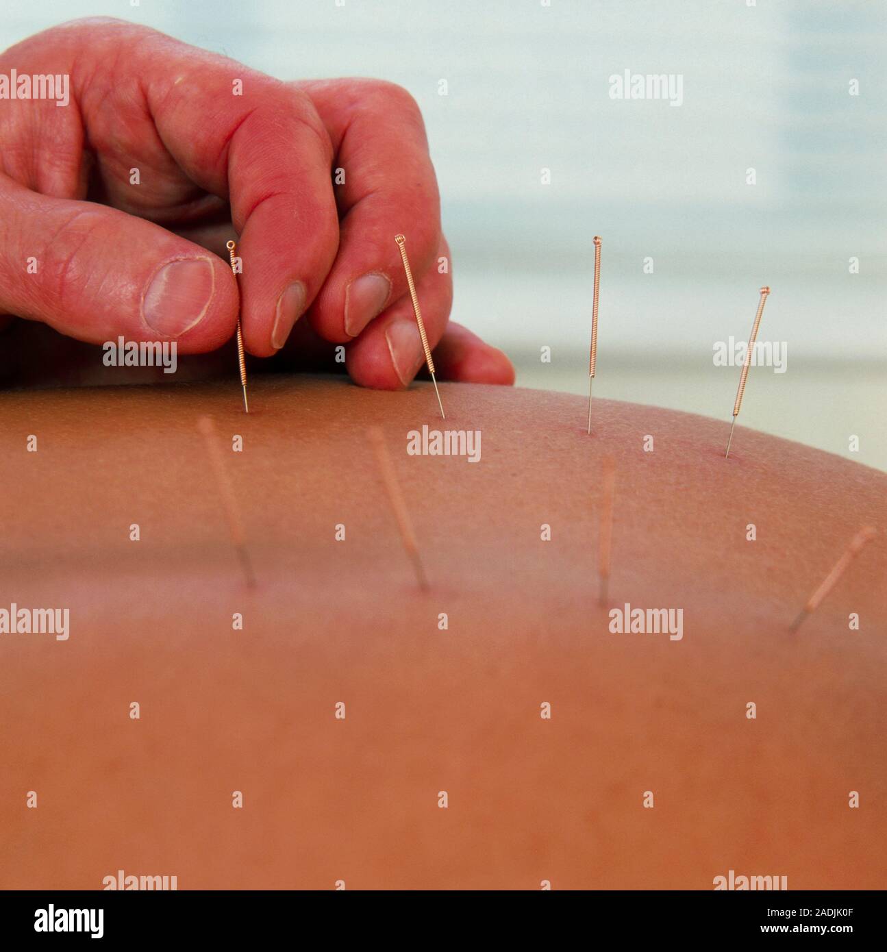 Acupuncture. Acupuncturist's hand inserting acupu- ncture needles into ...