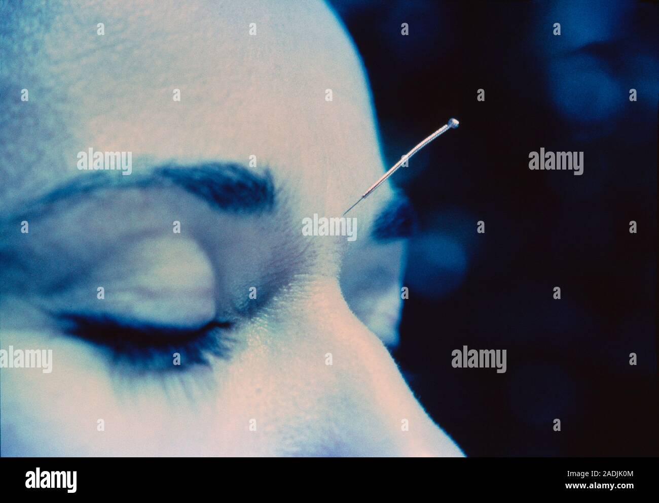 Acupuncture needle in a woman's forehead. These needles are placed in ...