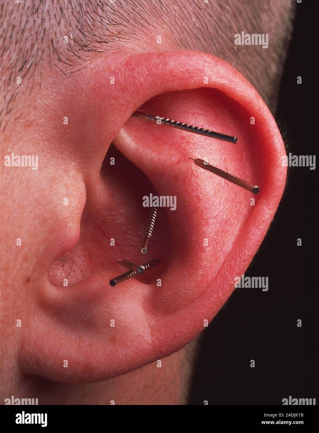 Ear acupuncture for the treatment of physical addiction, such as that ...
