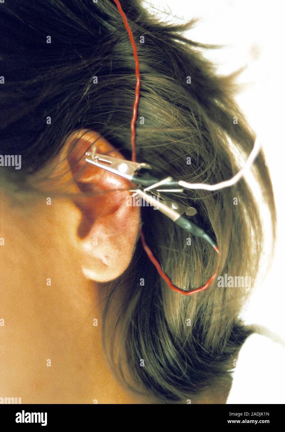 Ear electro-acupuncture to treat addiction to nicotine. Acupuncture is ...