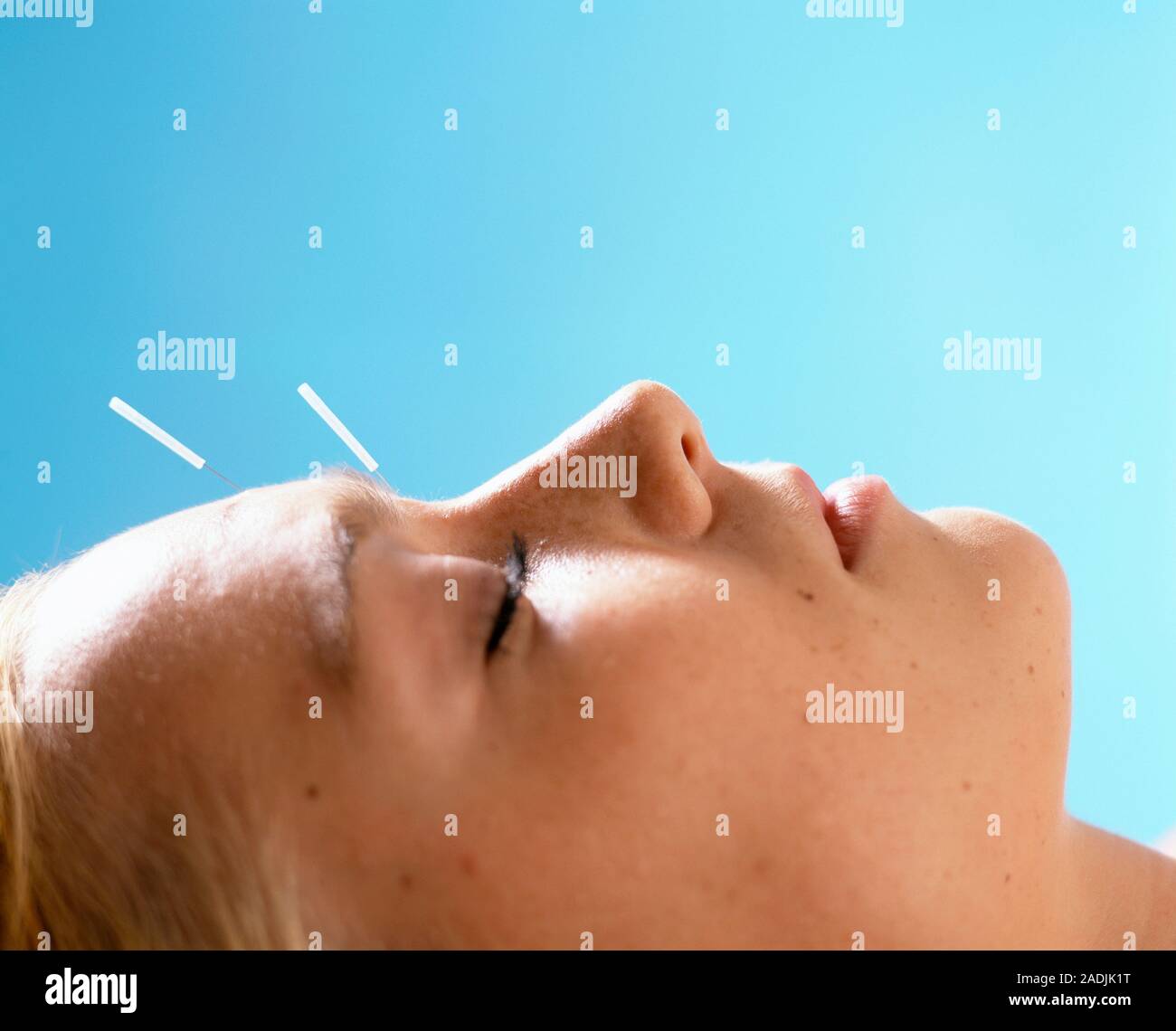 Acupuncture needles in a woman's forehead. This traditional Chinese ...