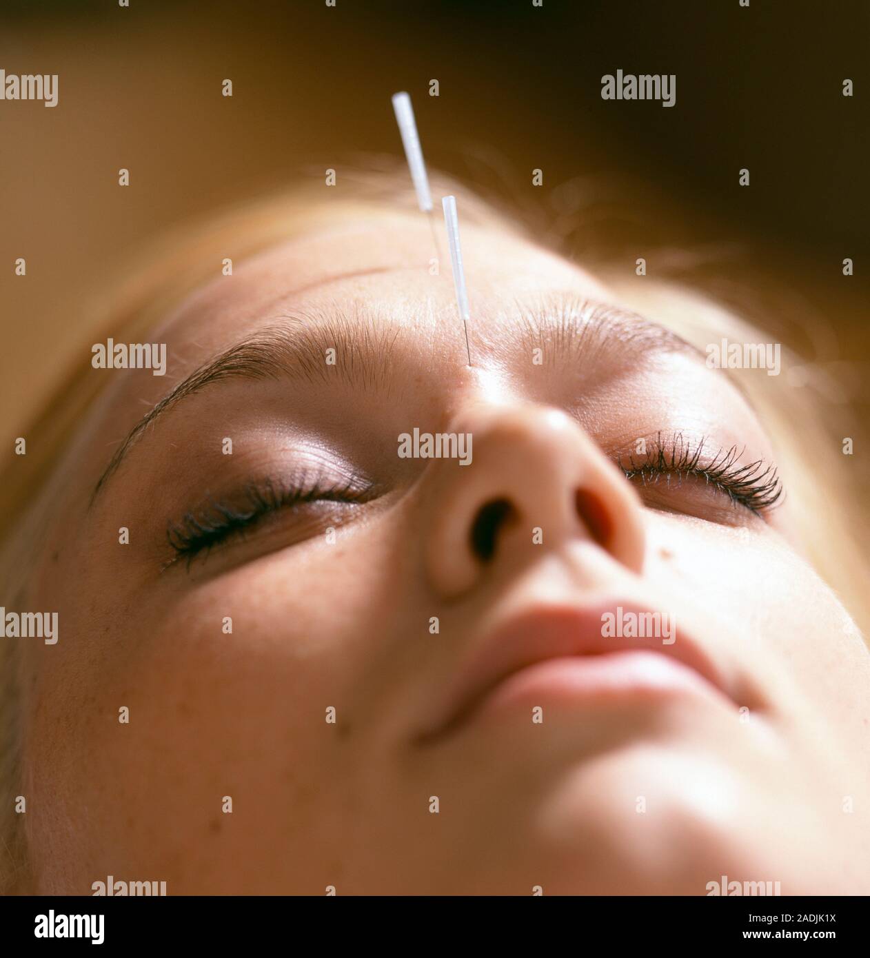 Acupuncture needles in a woman's forehead. This traditional Chinese ...