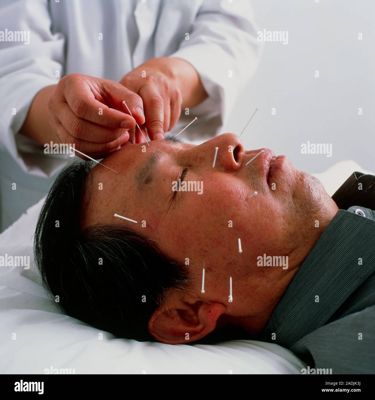 Acupuncture. Acupuncturist inserting needles into a man's face. These ...