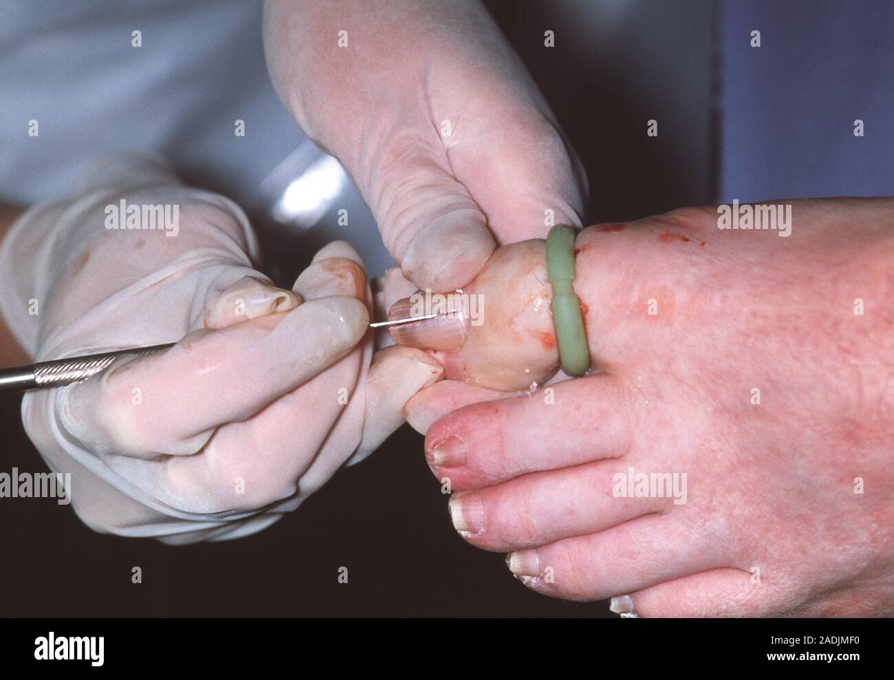 Toenail removal. Chiropodist's gloved hands use a scalpel to remove a ...