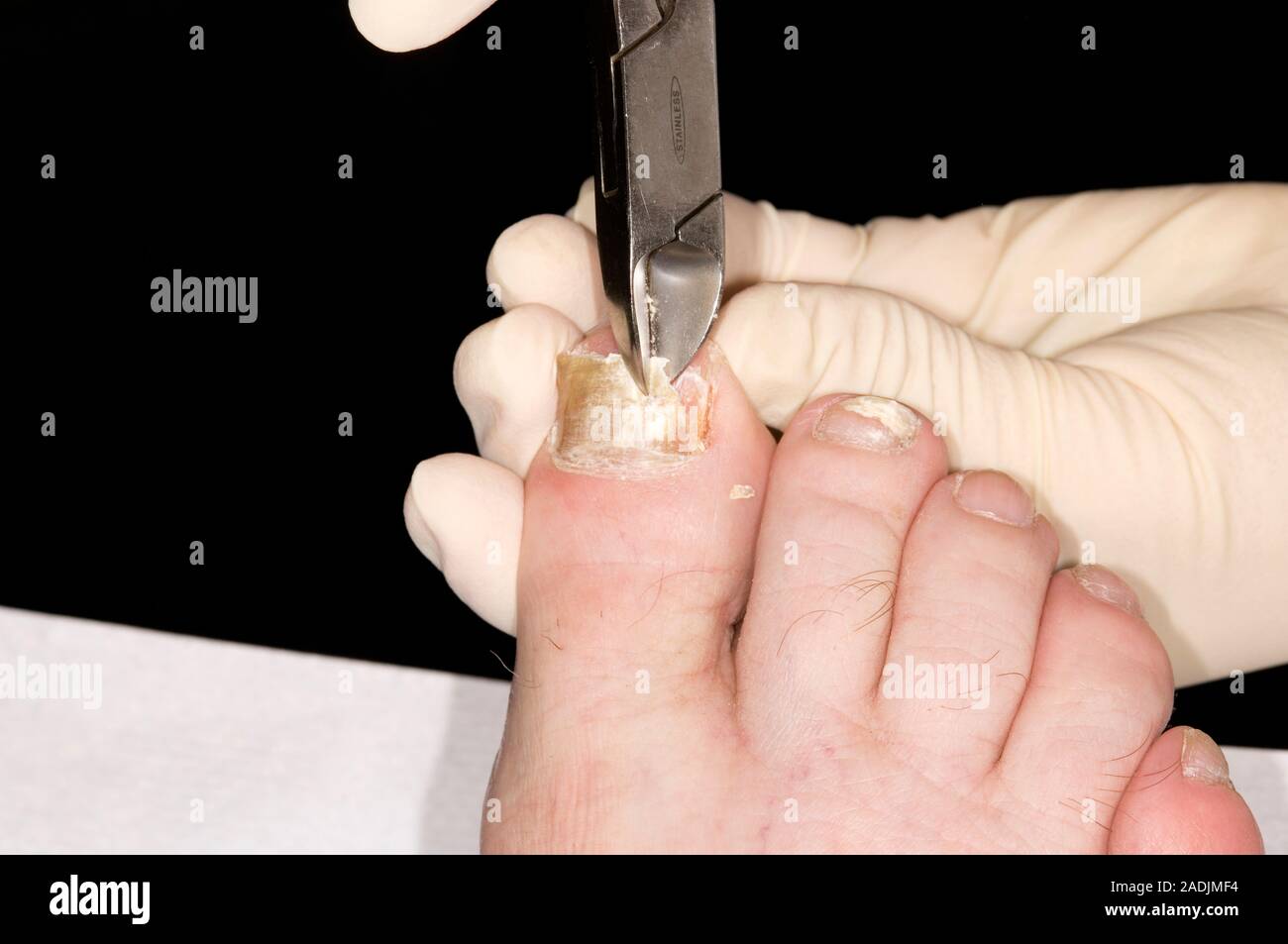 Fungal nail infection. Chiropodist cutting a specimen from a patient's ...