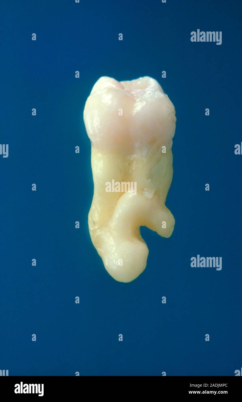 Wisdom tooth, showing the abnormal root to accomodate mandibular nerve ...