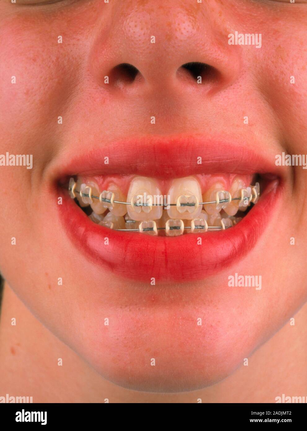 Dental braces fixed to the teeth of a girl. Fixed braces consist of ...