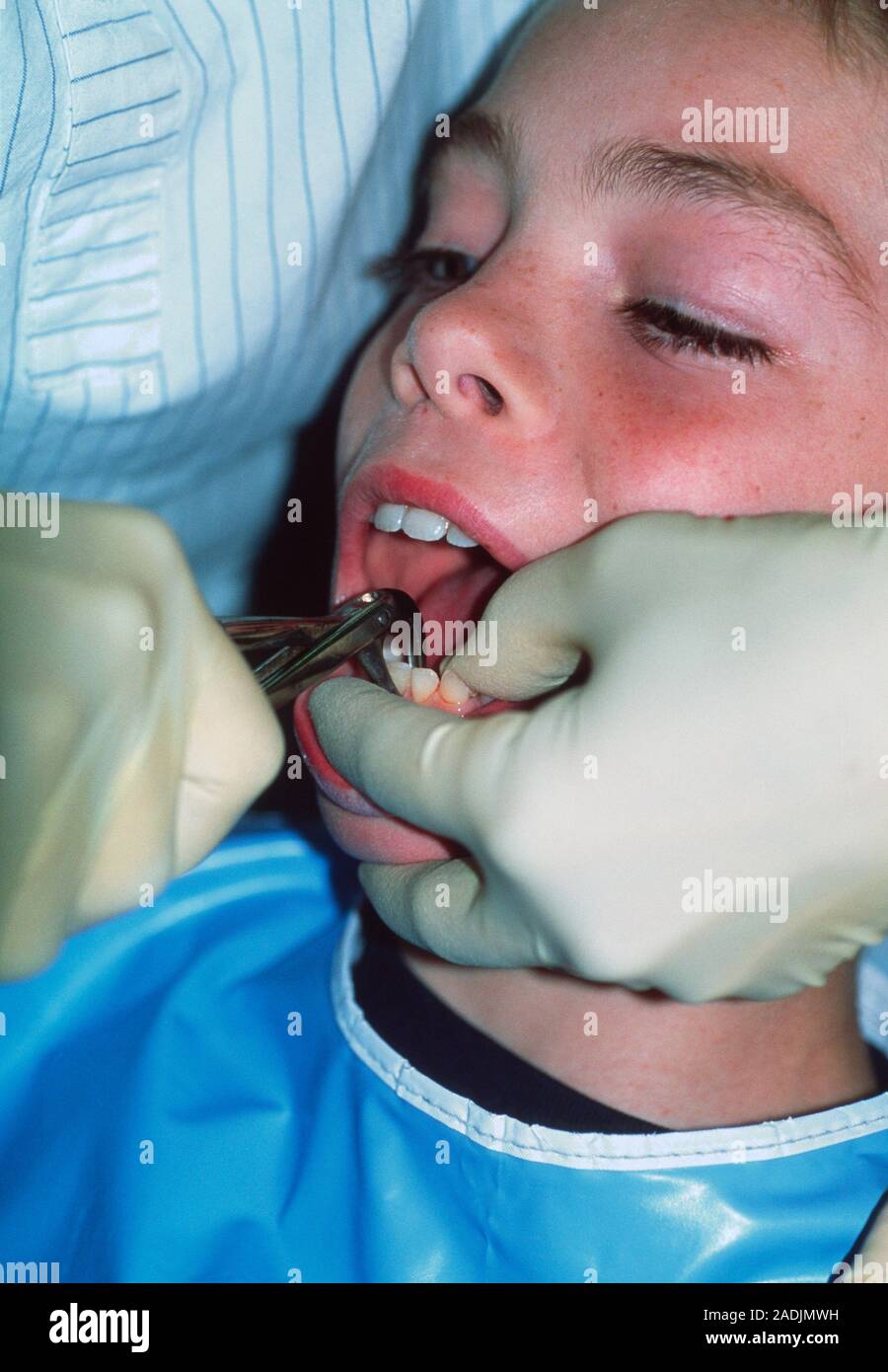 Tooth extraction. Dentist using pliers to remove an extra incisor tooth ...